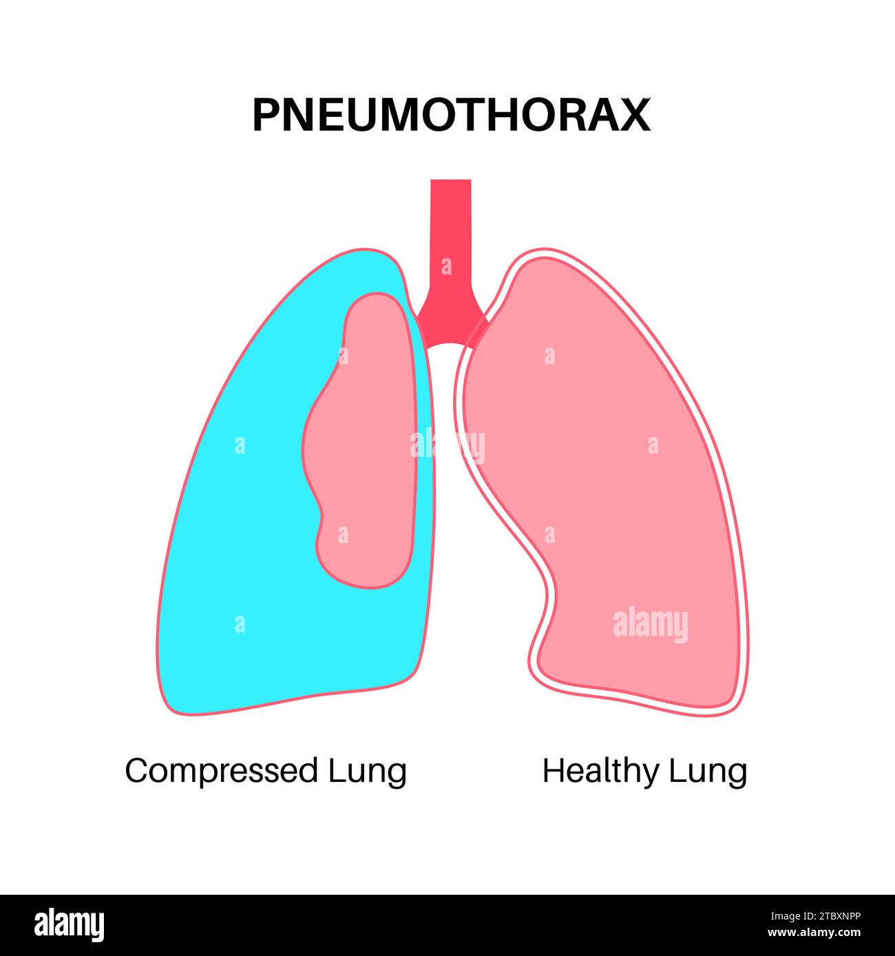 Pneumothorax collapsed lung hi-res stock photography and images - Alamy
