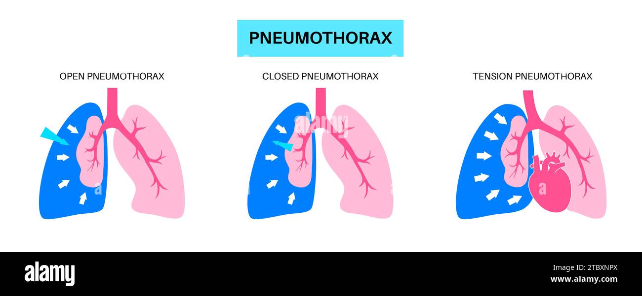 Pneumothorax collapsed lung Cut Out Stock Images & Pictures - Alamy