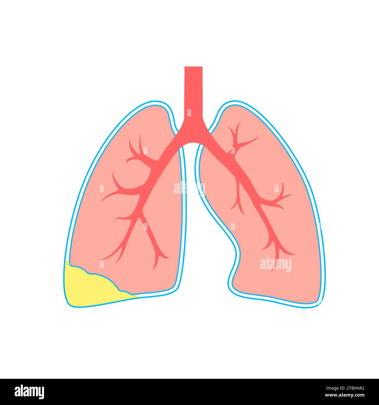 Pyothorax, or pleural empyema, illustration Stock Photo - Alamy