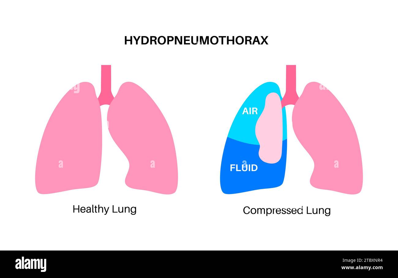 Hydropneumothoraces hi-res stock photography and images - Alamy