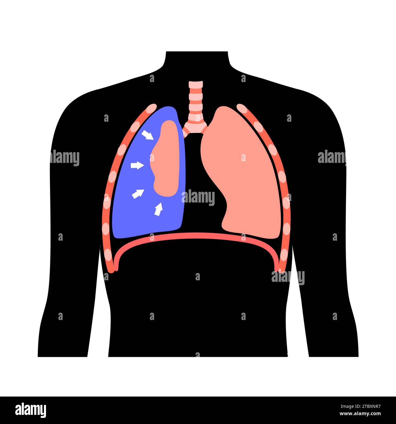 Pneumothorax collapsed lung hi-res stock photography and images - Alamy