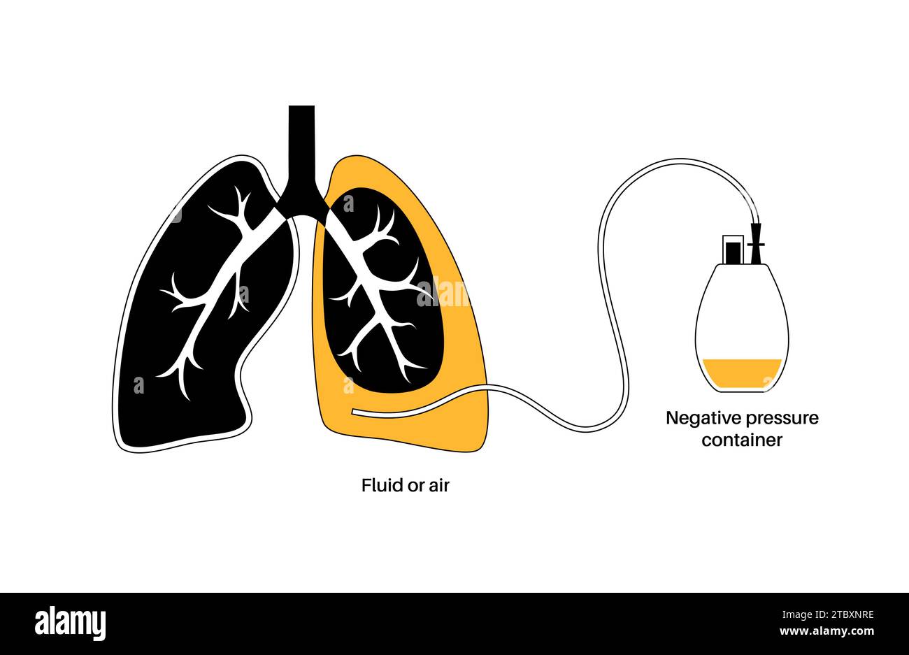 Tunnelled pleural catheter, illustration Stock Photo - Alamy