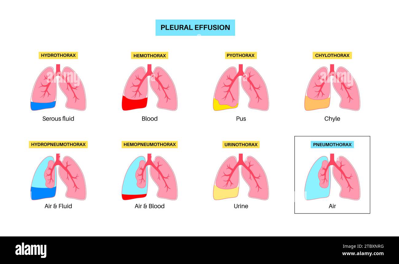 Pleural effusion, illustration Stock Photo - Alamy