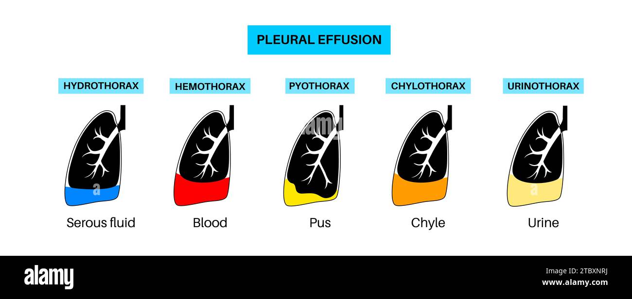 Pleural effusion, illustration Stock Photo - Alamy