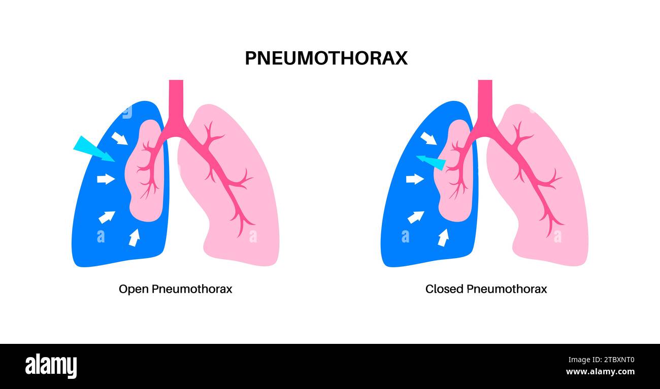 Pneumothorax collapsed lung hi-res stock photography and images - Alamy