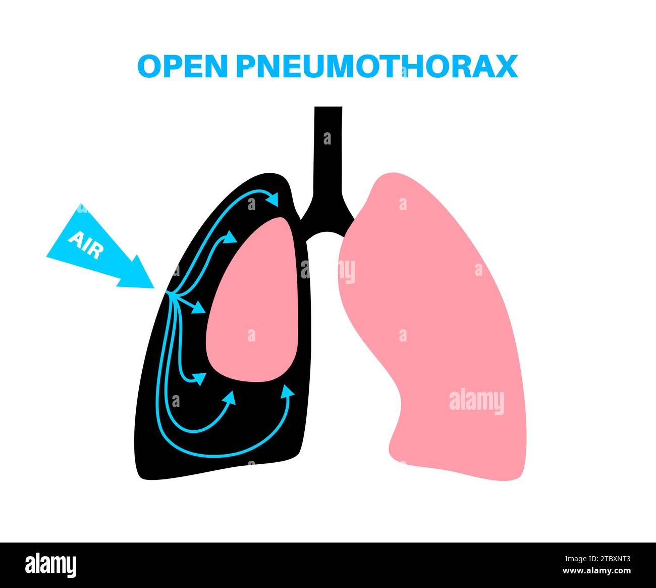 Pneumothorax collapsed lung hi-res stock photography and images - Alamy