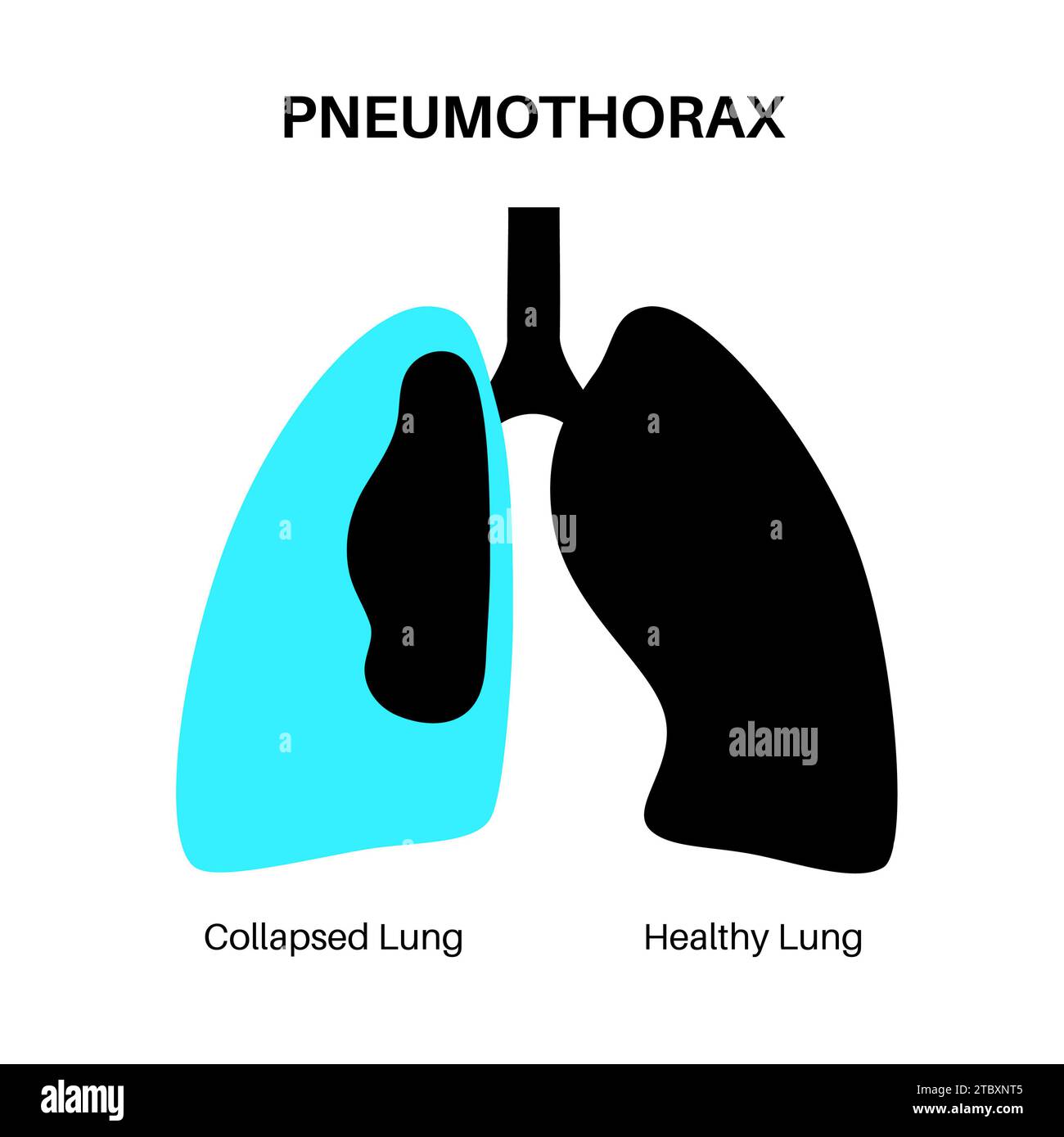 Pneumothorax collapsed lung hi-res stock photography and images - Alamy