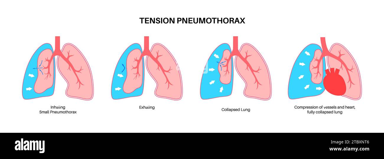 Tension pneumothorax hi-res stock photography and images - Alamy