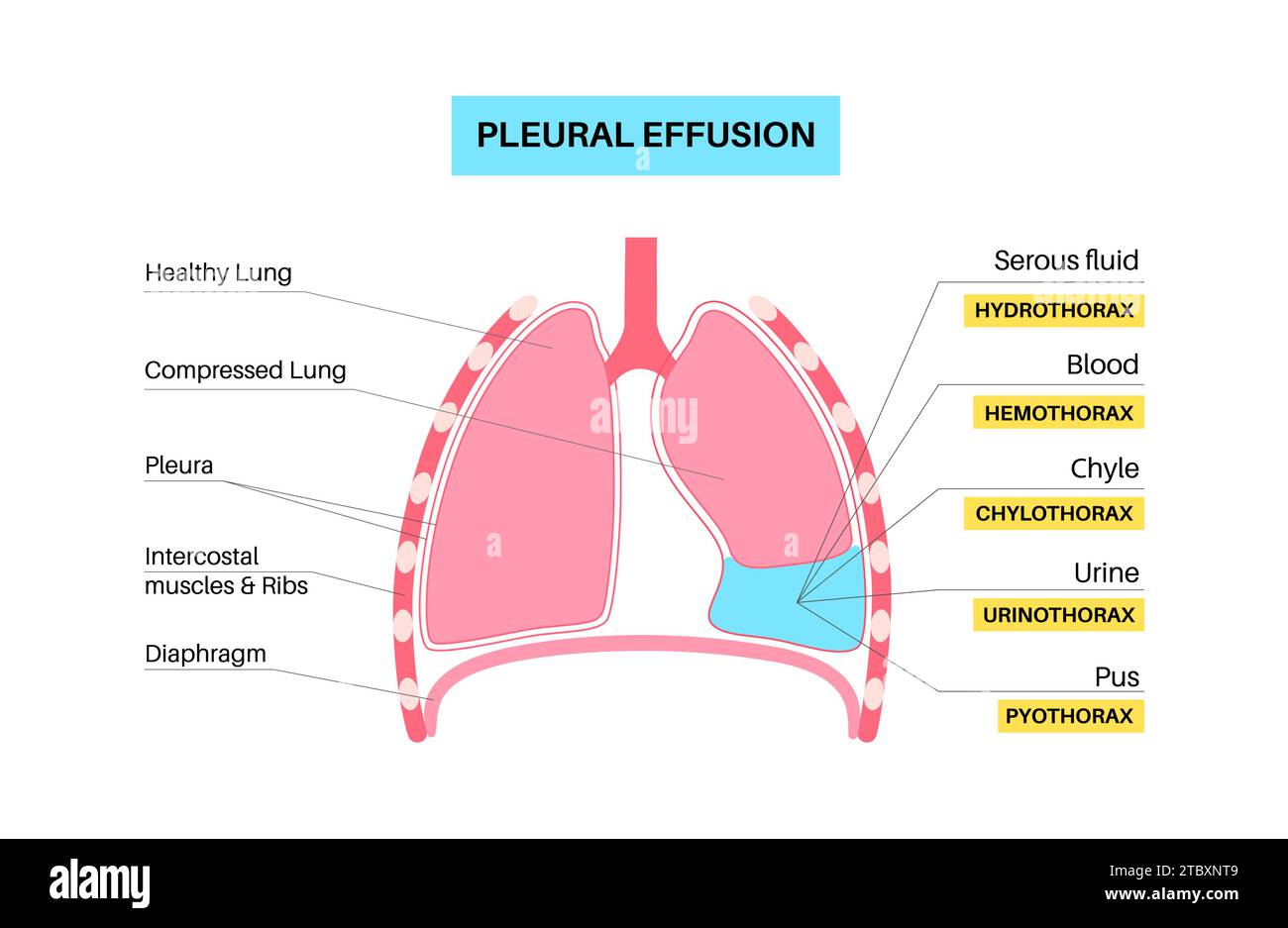 Pleural effusion, illustration Stock Photo - Alamy
