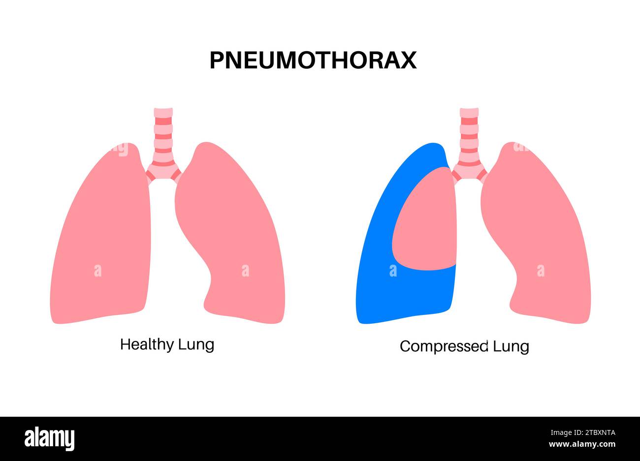Pneumothorax collapsed lung hi-res stock photography and images - Alamy