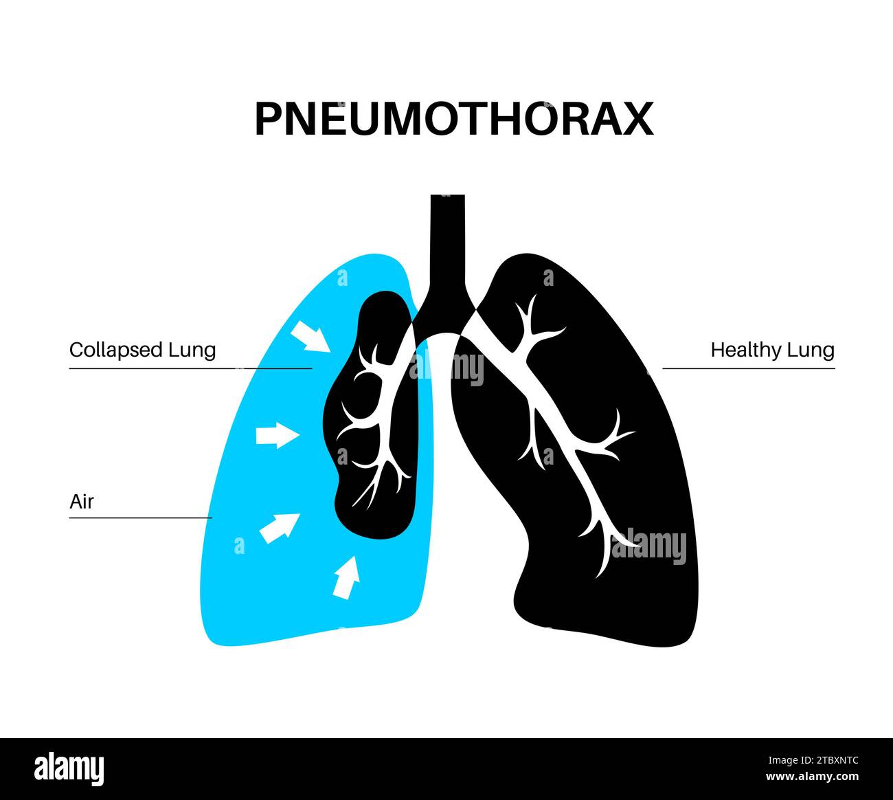 Pneumothorax collapsed lung hi-res stock photography and images - Alamy
