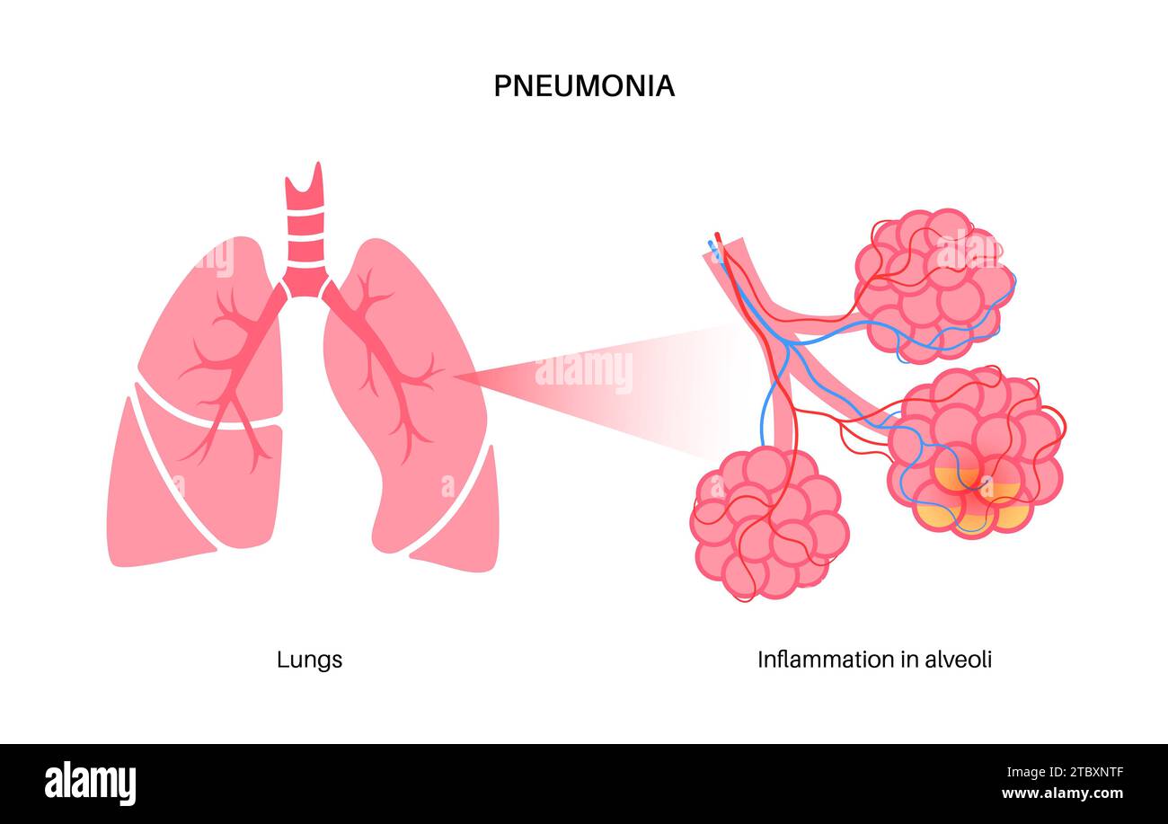 Pneumonia infection, conceptual illustration Stock Photo - Alamy