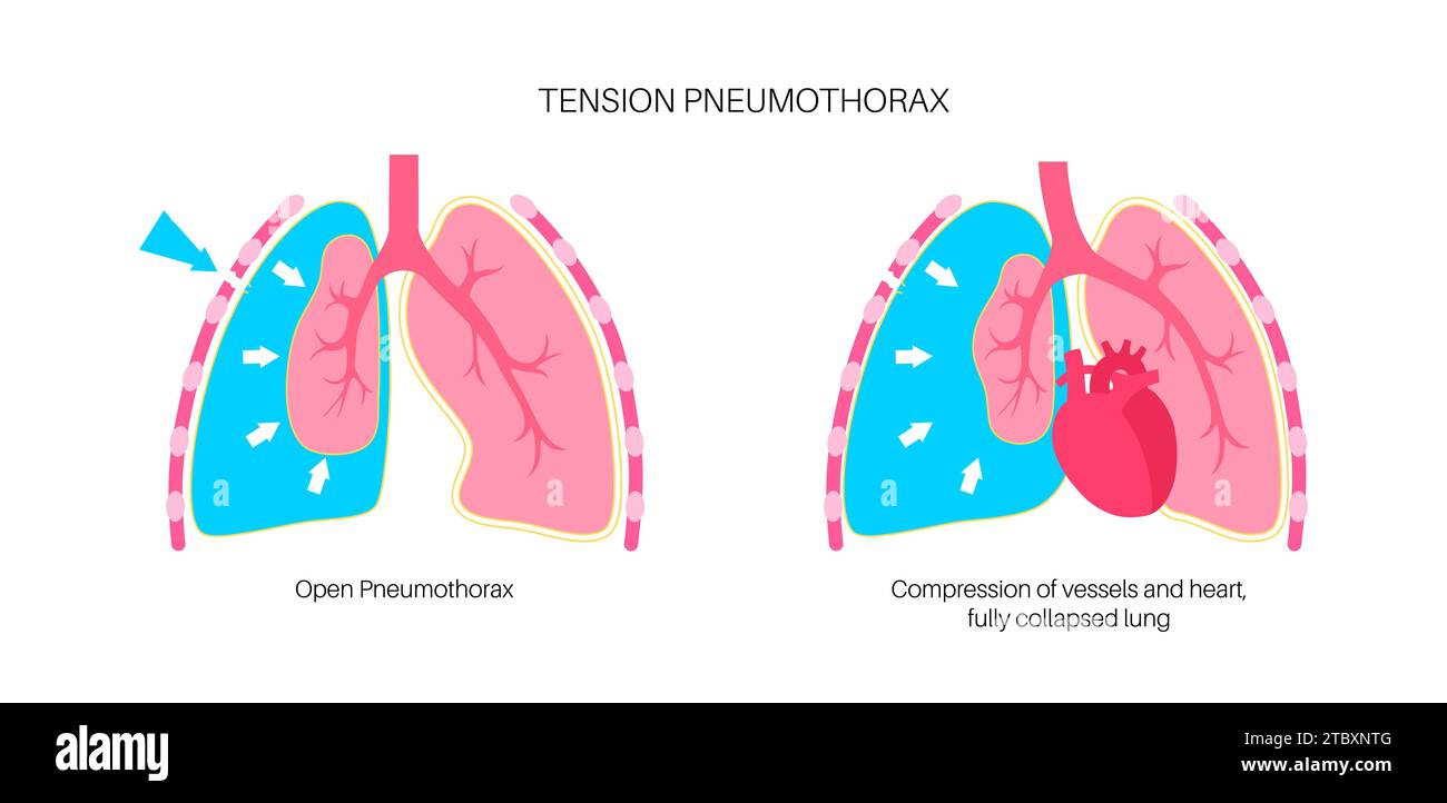 Tension pneumothorax, illustration Stock Photo - Alamy