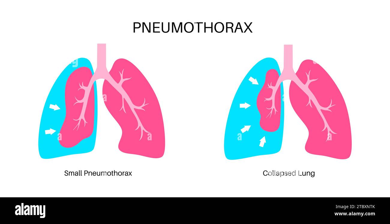 Pneumothorax collapsed lung hi-res stock photography and images - Alamy