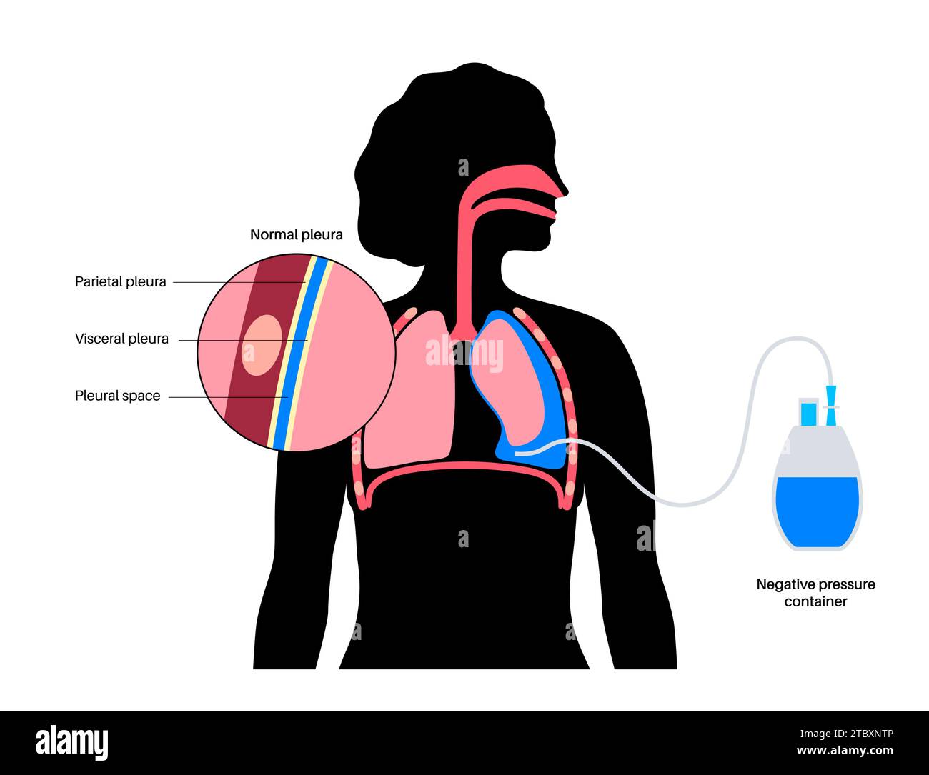 Tunnelled pleural catheter, illustration Stock Photo - Alamy