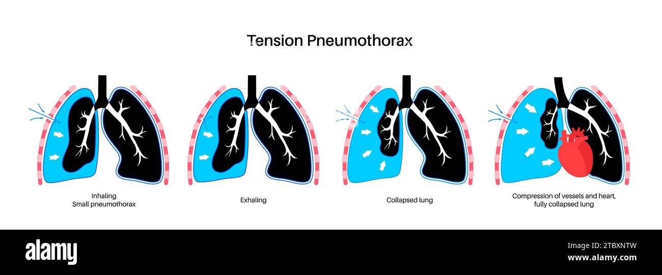 Tension pneumothorax hi-res stock photography and images - Alamy