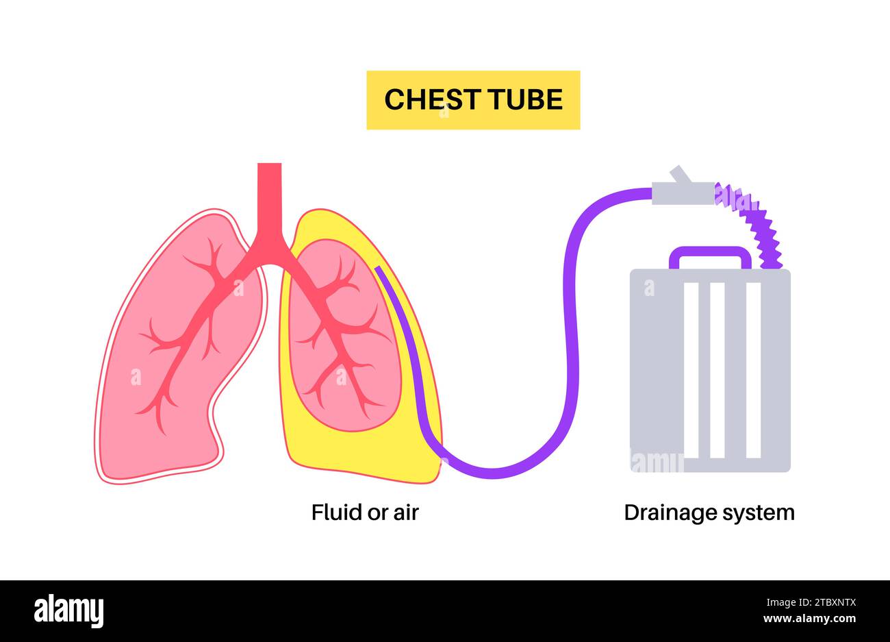 Chest tube catheter, illustration Stock Photo - Alamy