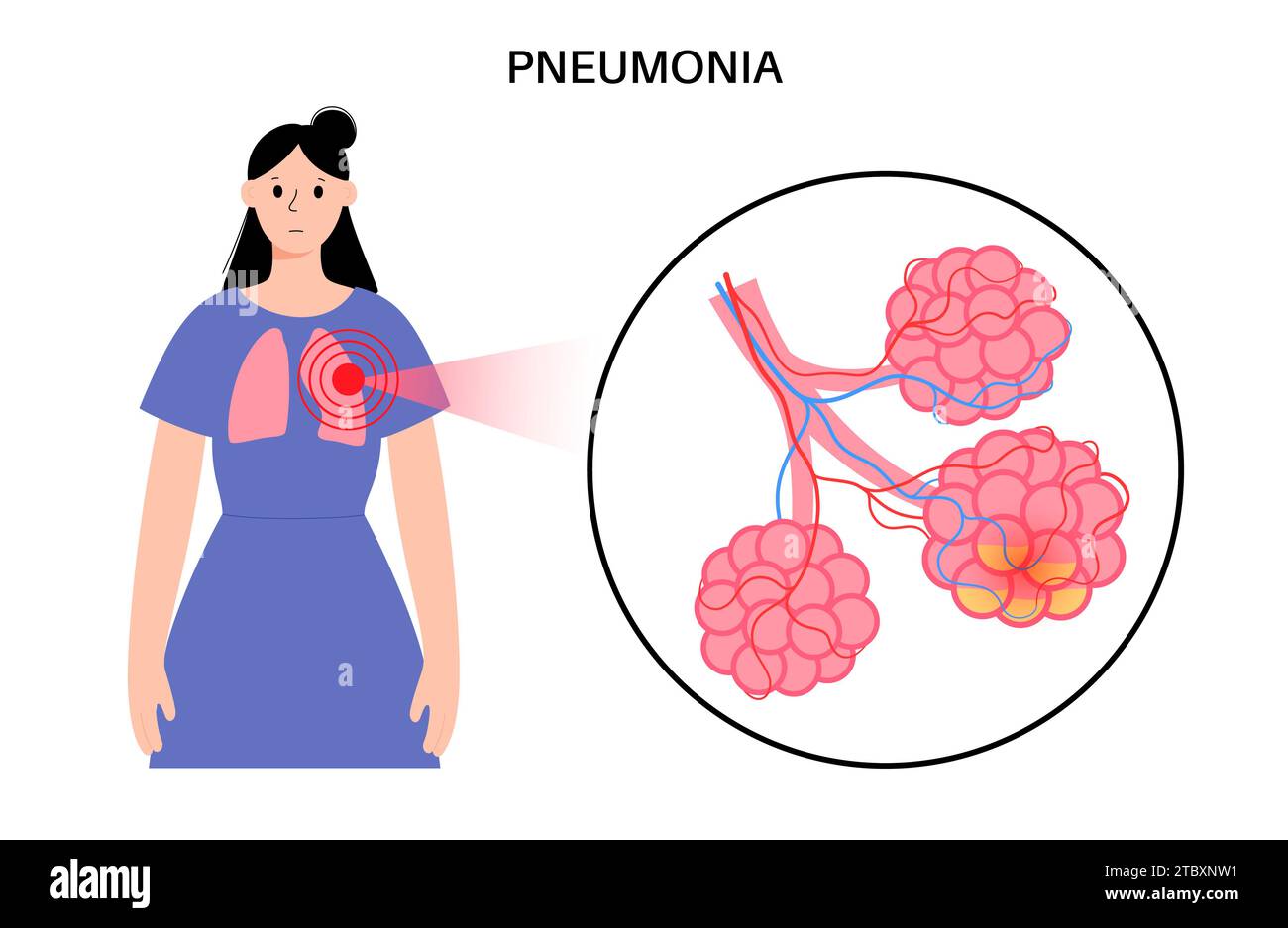 Pneumonia infection, conceptual illustration Stock Photo - Alamy