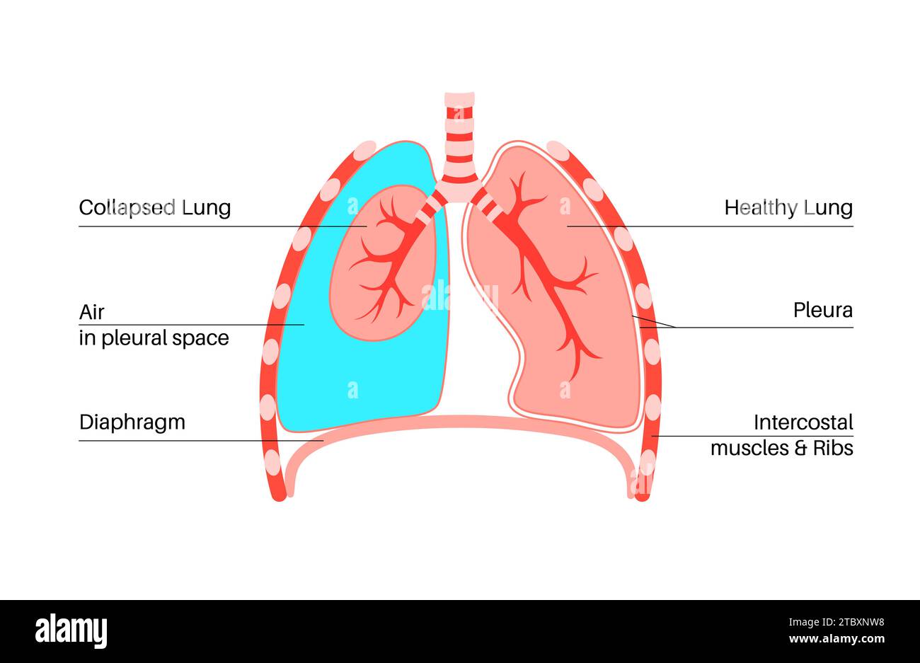 Pneumothorax collapsed lung hi-res stock photography and images - Alamy