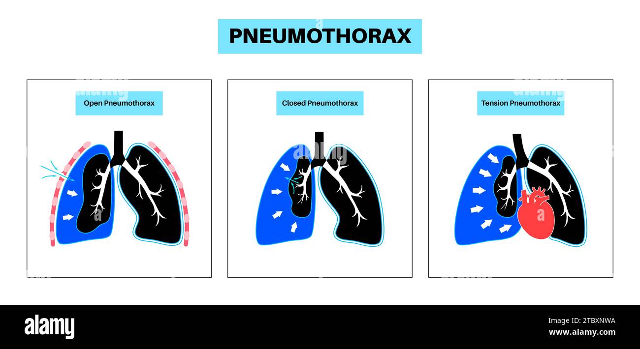 Pneumothorax collapsed lung hi-res stock photography and images - Alamy