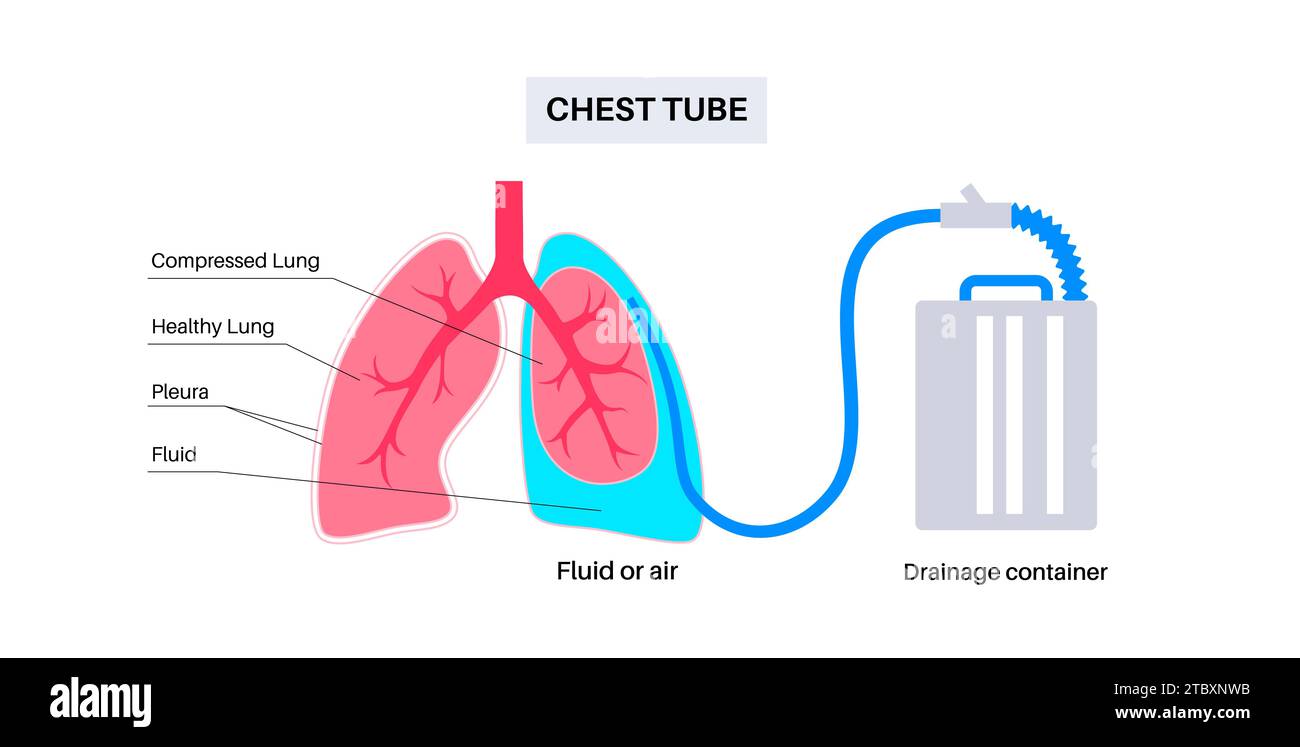 Chest tube catheter, illustration Stock Photo - Alamy