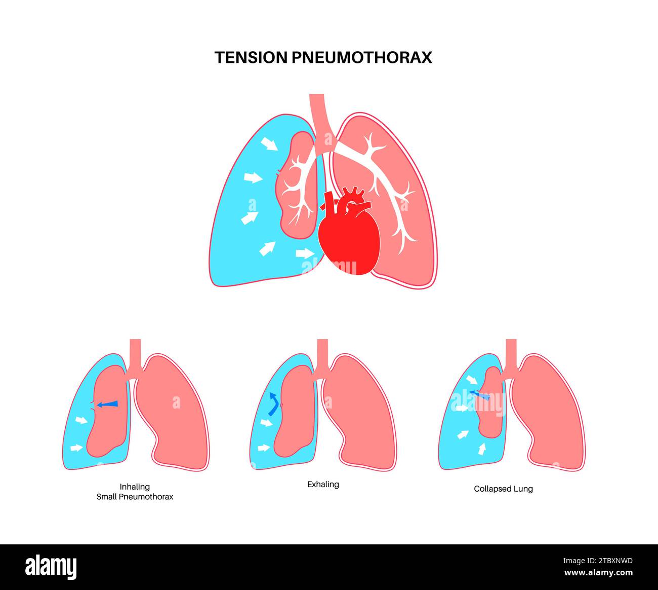 Tension pneumothorax hi-res stock photography and images - Alamy