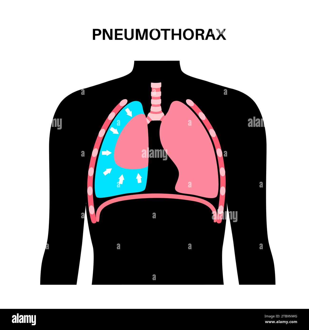 Pneumothorax collapsed lung hi-res stock photography and images - Alamy