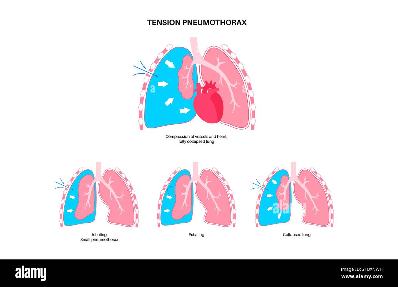 Tension disease Cut Out Stock Images & Pictures - Alamy