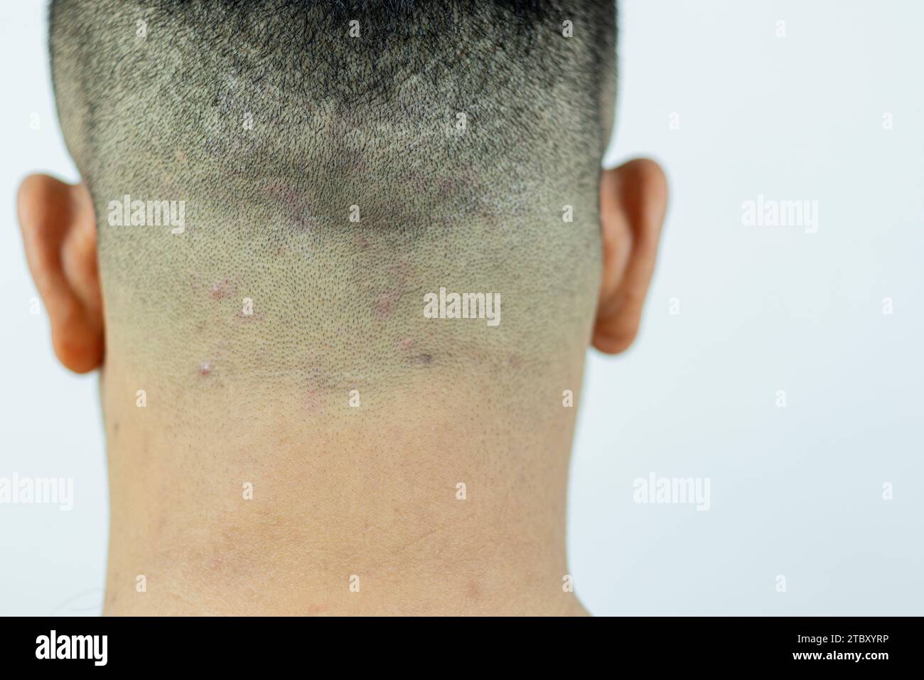 Close-up view of ringworm (tinea) on the head of an Asian man ...