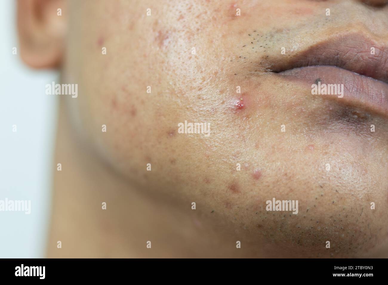 skin problems. problem of inflamed acne on the face. Inflamed acne ...