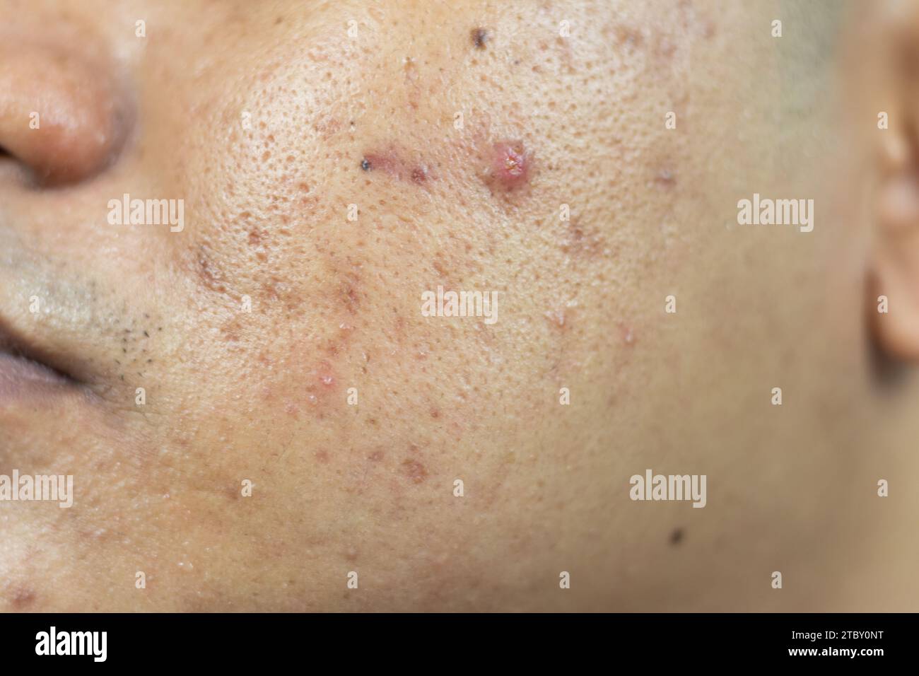 skin problems. problem of inflamed acne on the face. Inflamed acne ...