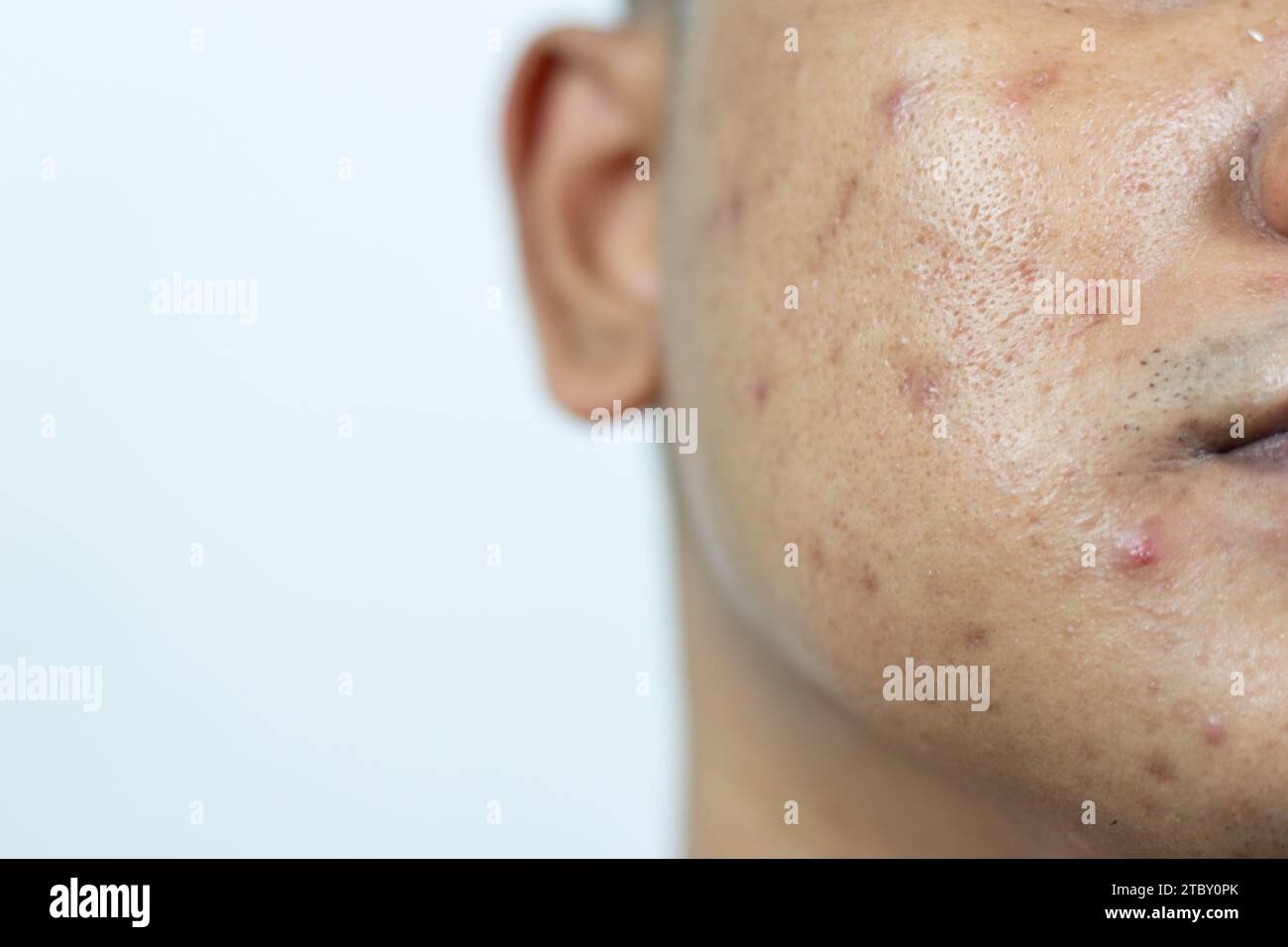 skin problems. problem of inflamed acne on the face. Inflamed acne ...