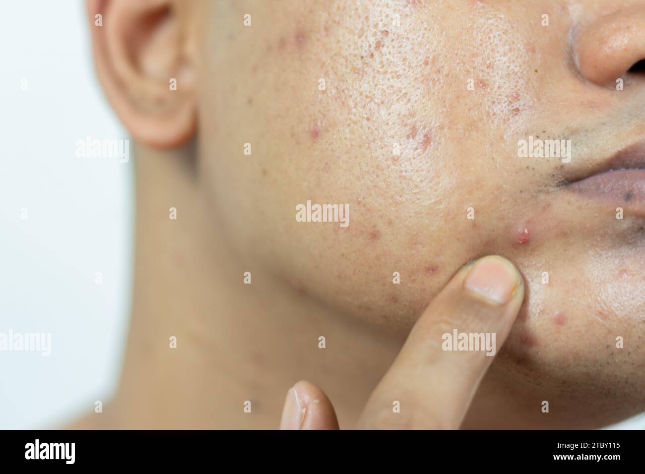 Scratch on cheek hi-res stock photography and images - Alamy