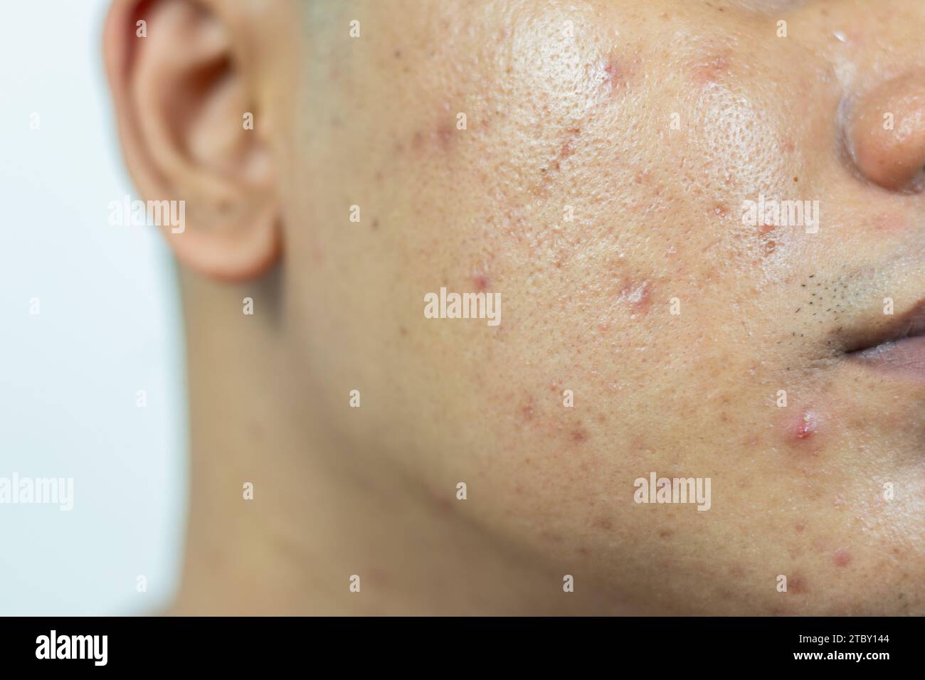 skin problems. problem of inflamed acne on the face. Inflamed acne ...