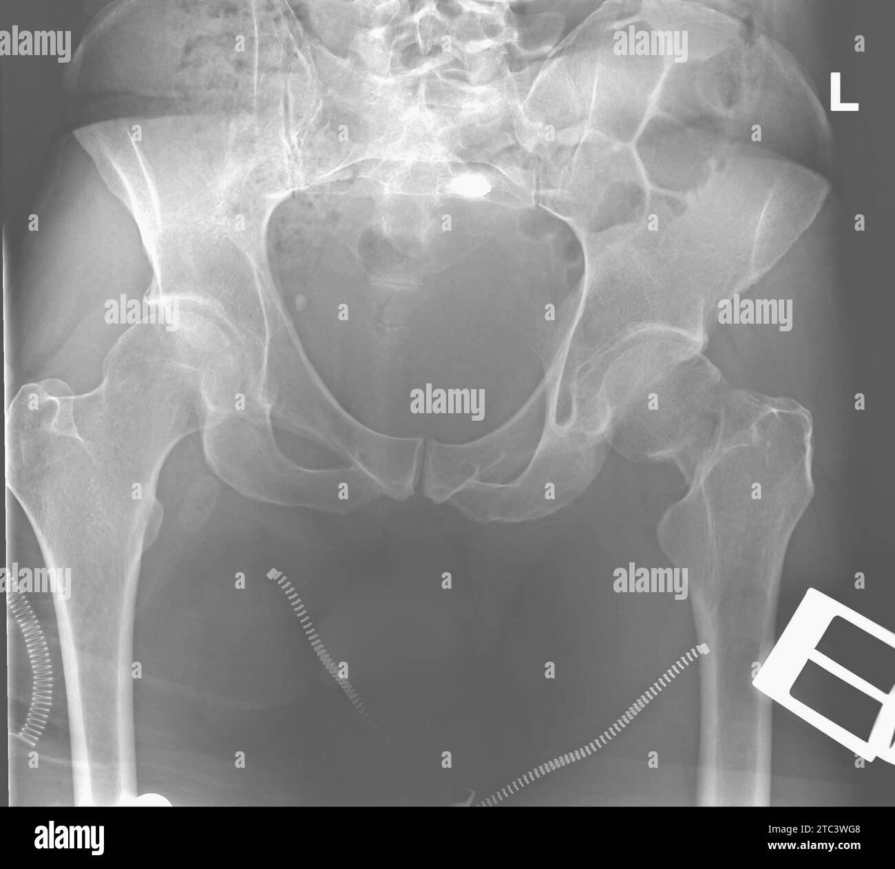 Femoral neck fracture hi-res stock photography and images - Alamy