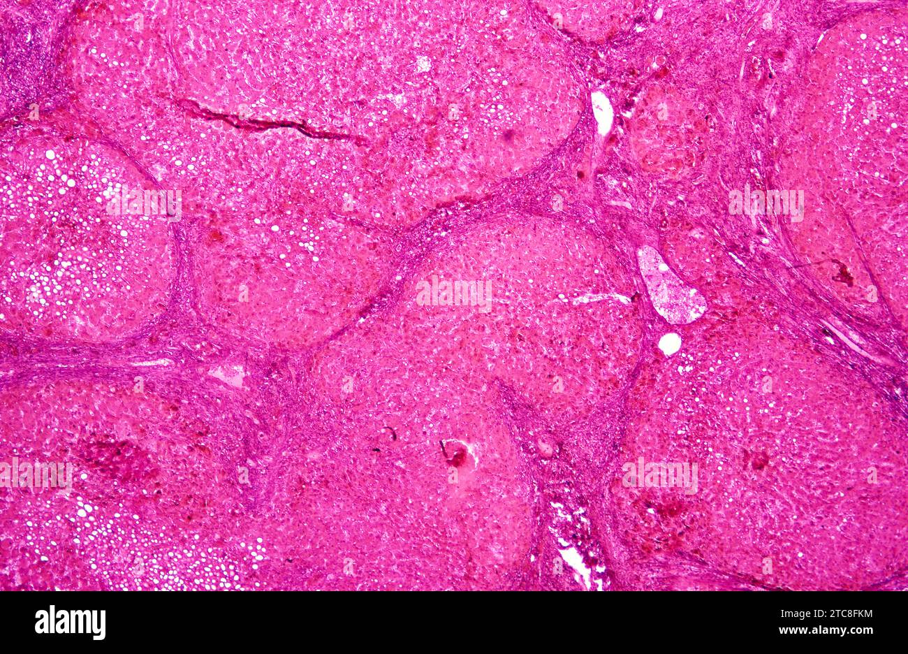 Human cirrhotic liver. Optical microscope. Magnification X100 Stock ...