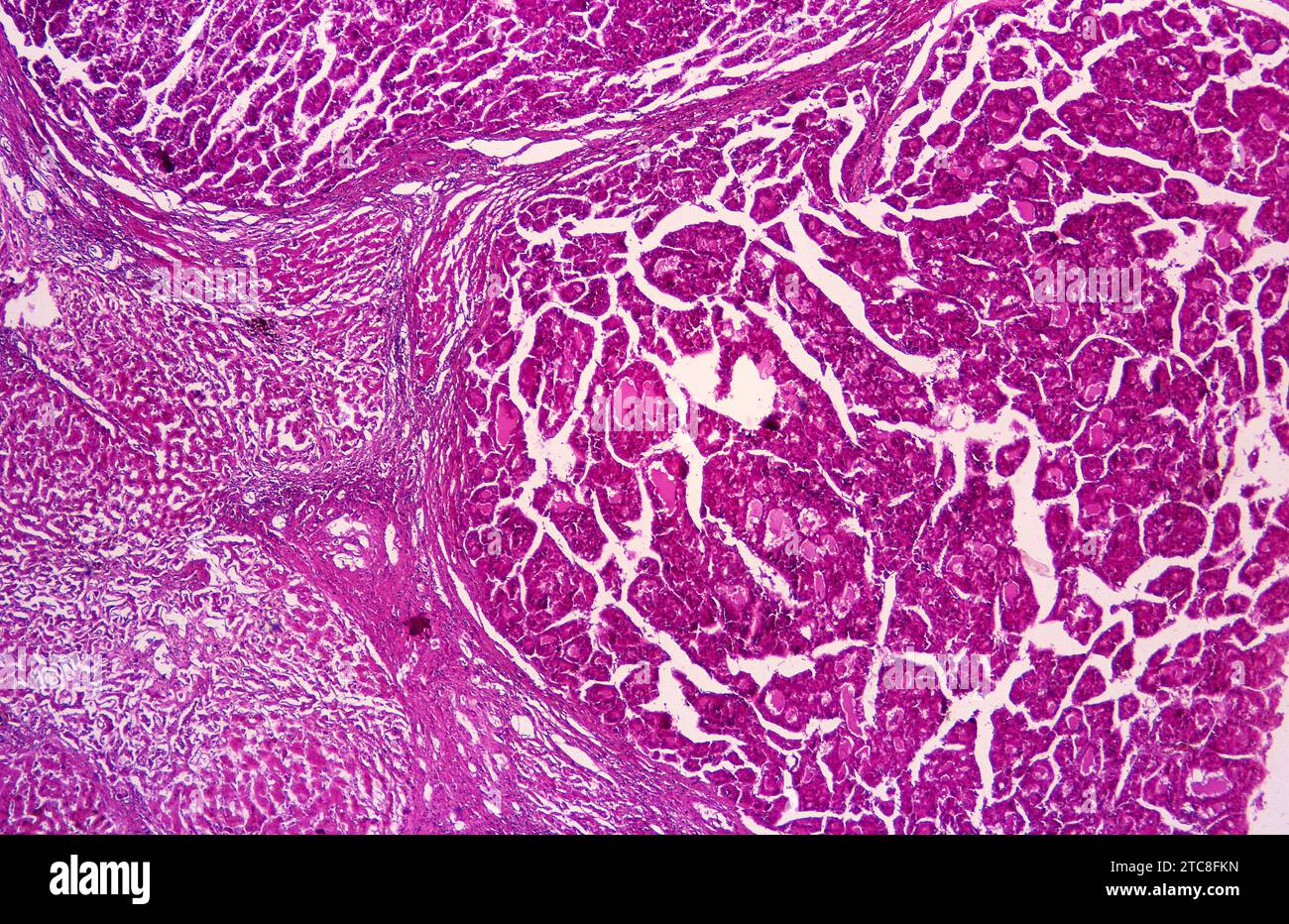 Human liver cancer or hepatic cancer. Optical microscope. Magnification ...