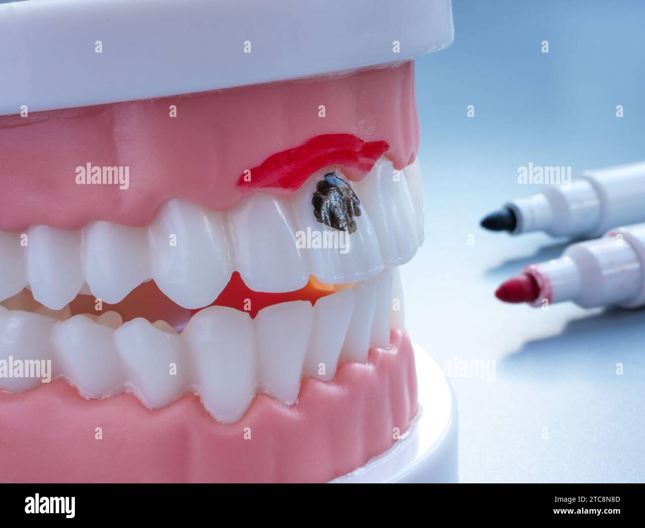 Plastic jaw and marks showing gum disease and tooth decay Stock Photo ...