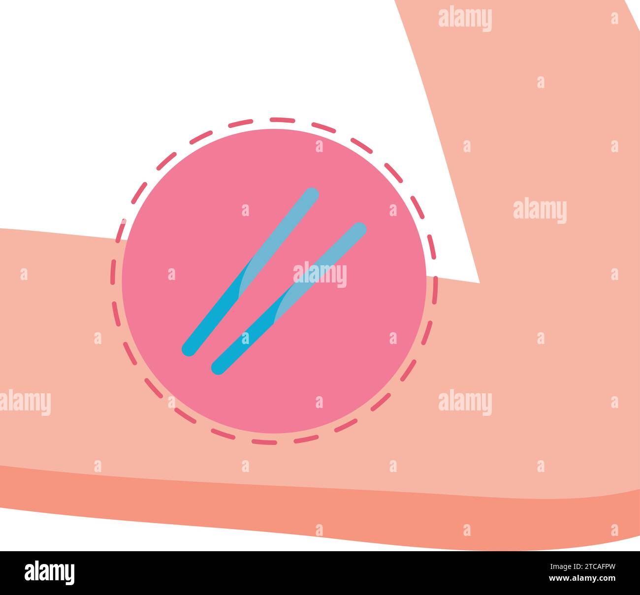 Hormone implant hi-res stock photography and images - Alamy