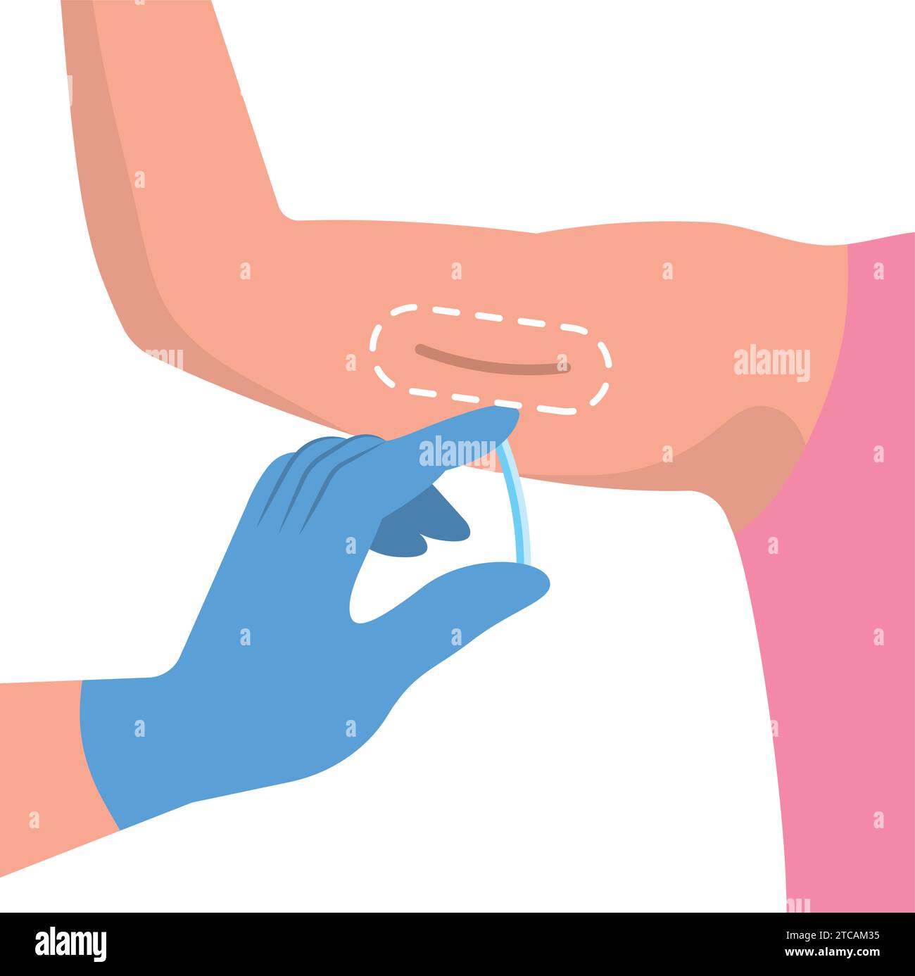 contraceptive implant birth control Stock Vector Image & Art - Alamy