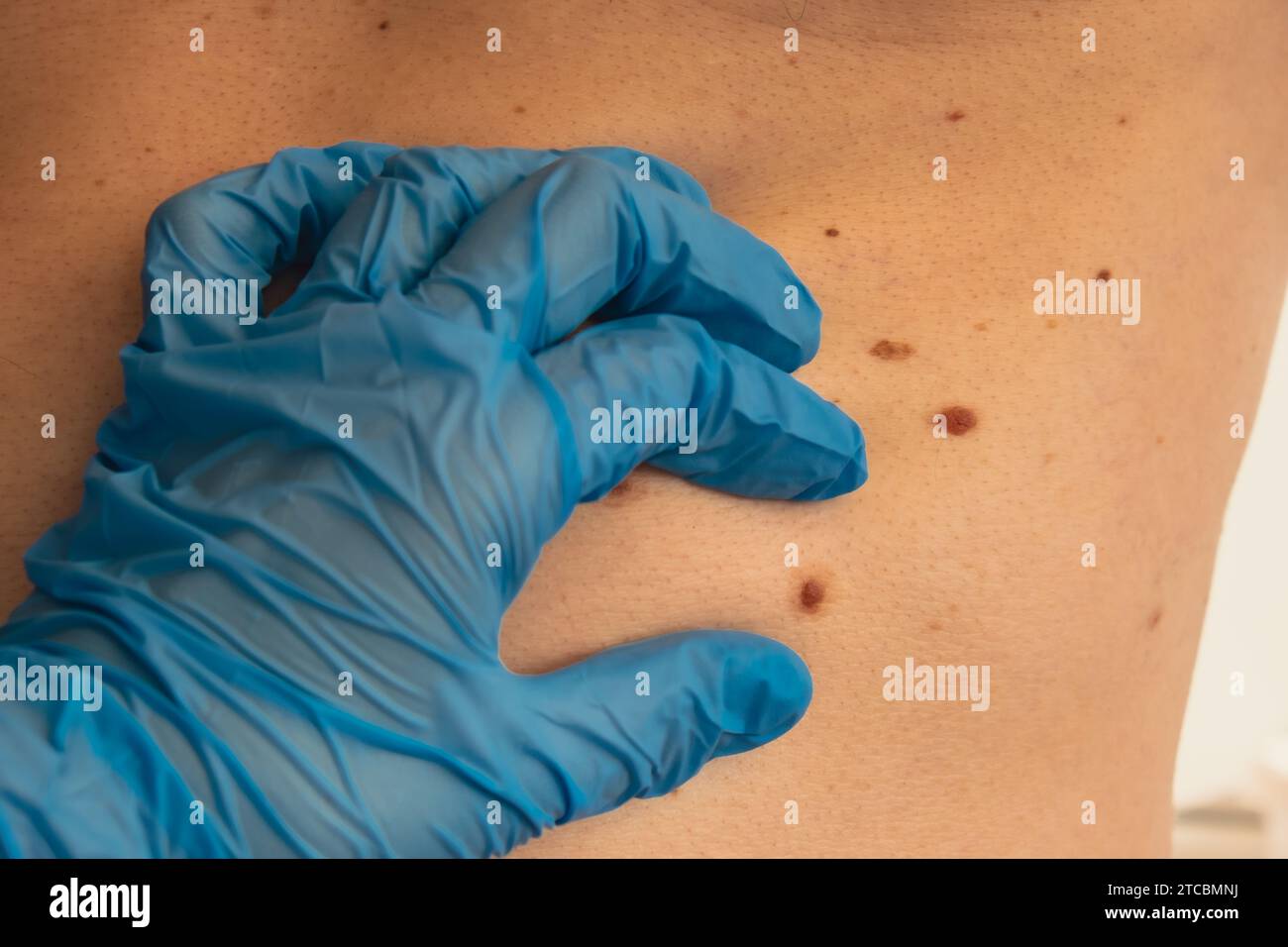 Doctor in medical gloves examining man skin mole. Dermatologist ...
