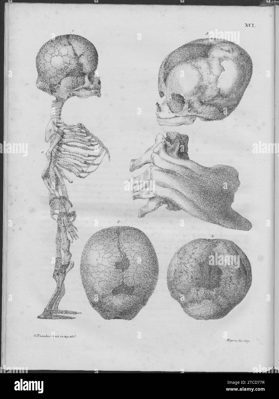 Willem Vrolik's specimen of an infant with osteogenesis imperfecta ...
