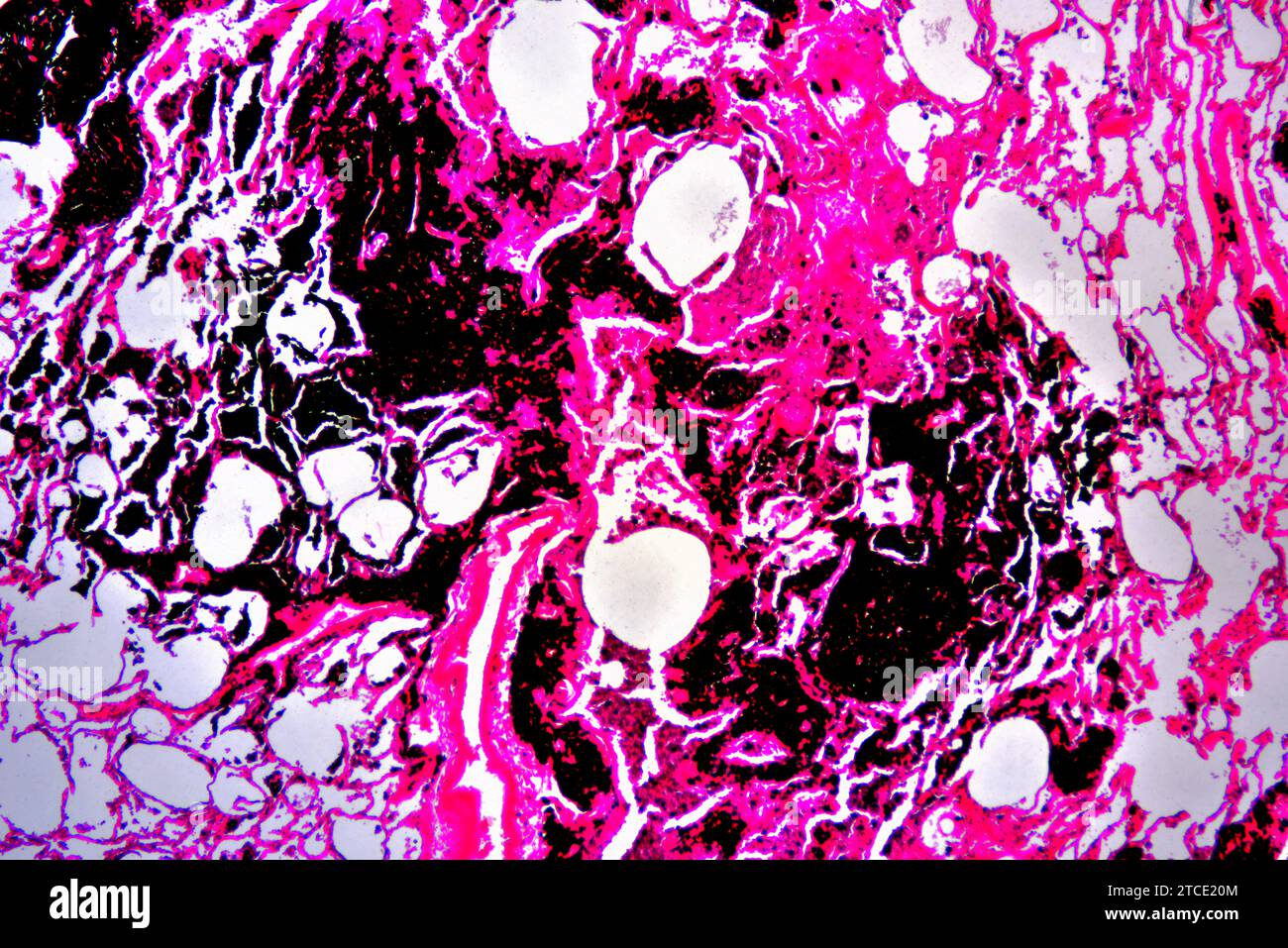 Micrograph human lung alveoli hi-res stock photography and images - Alamy