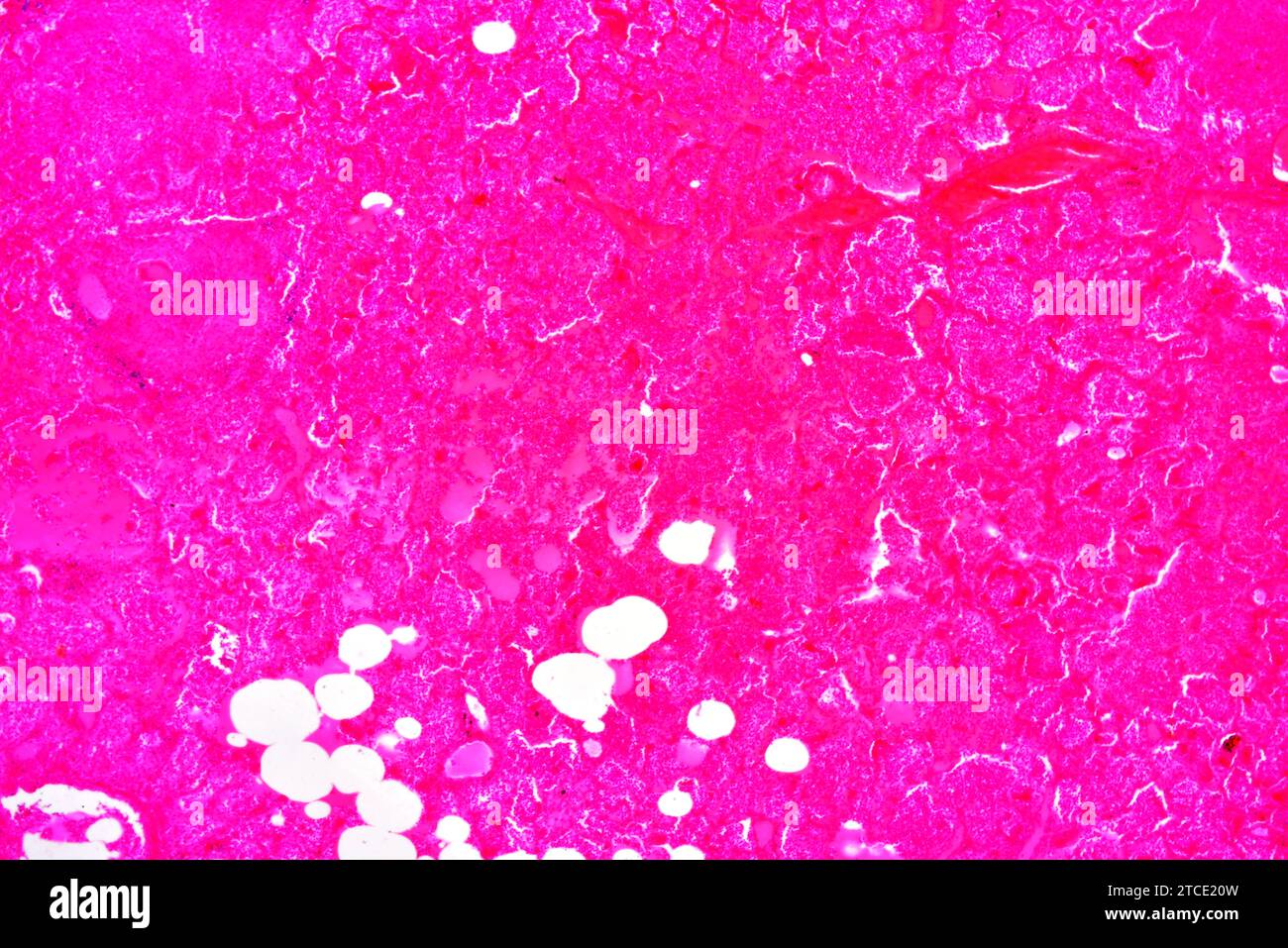 Human tuberculosis lung section. Optical microscope X40 Stock Photo - Alamy