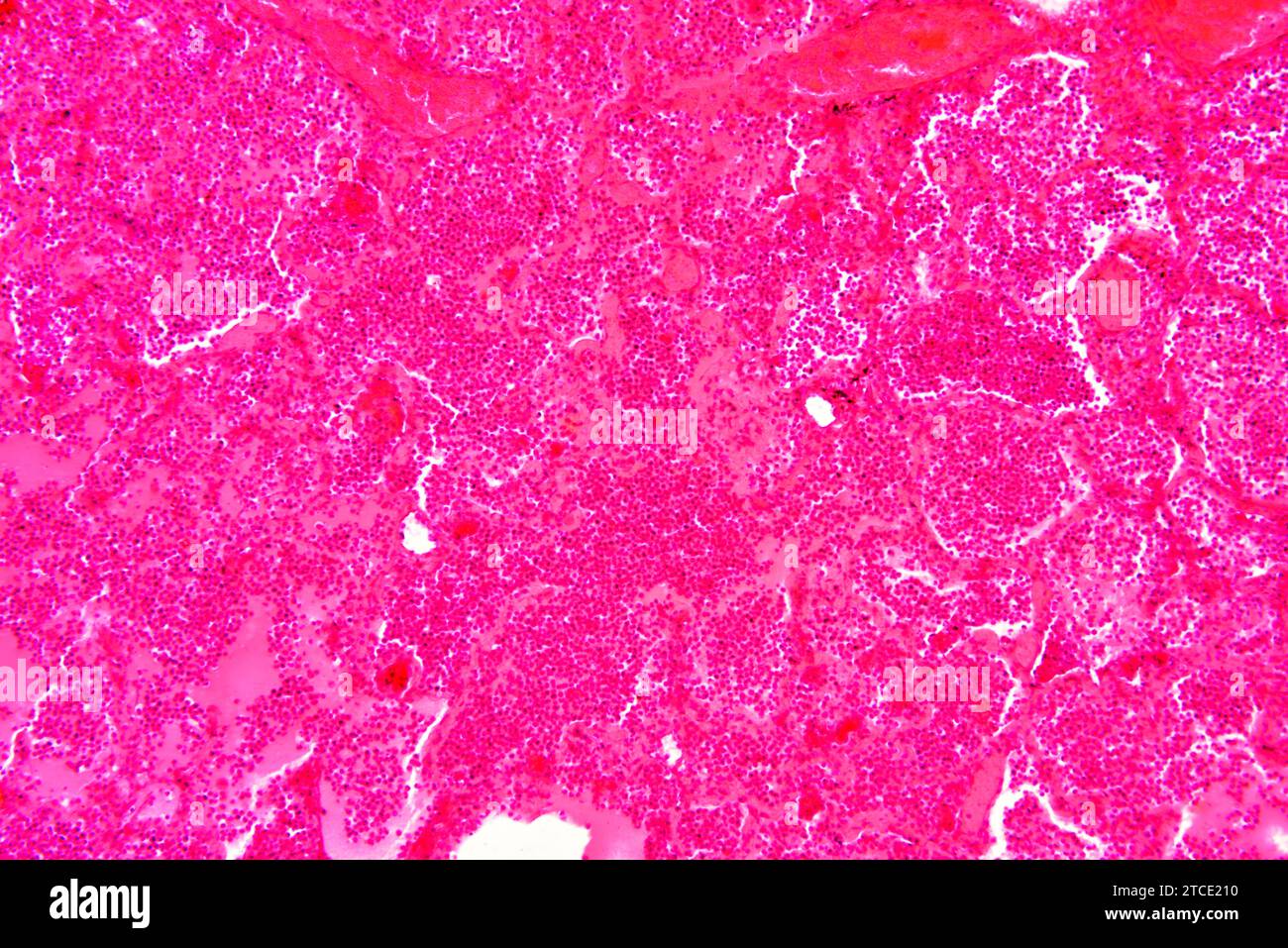 Tuberculosis microscope hi-res stock photography and images - Alamy