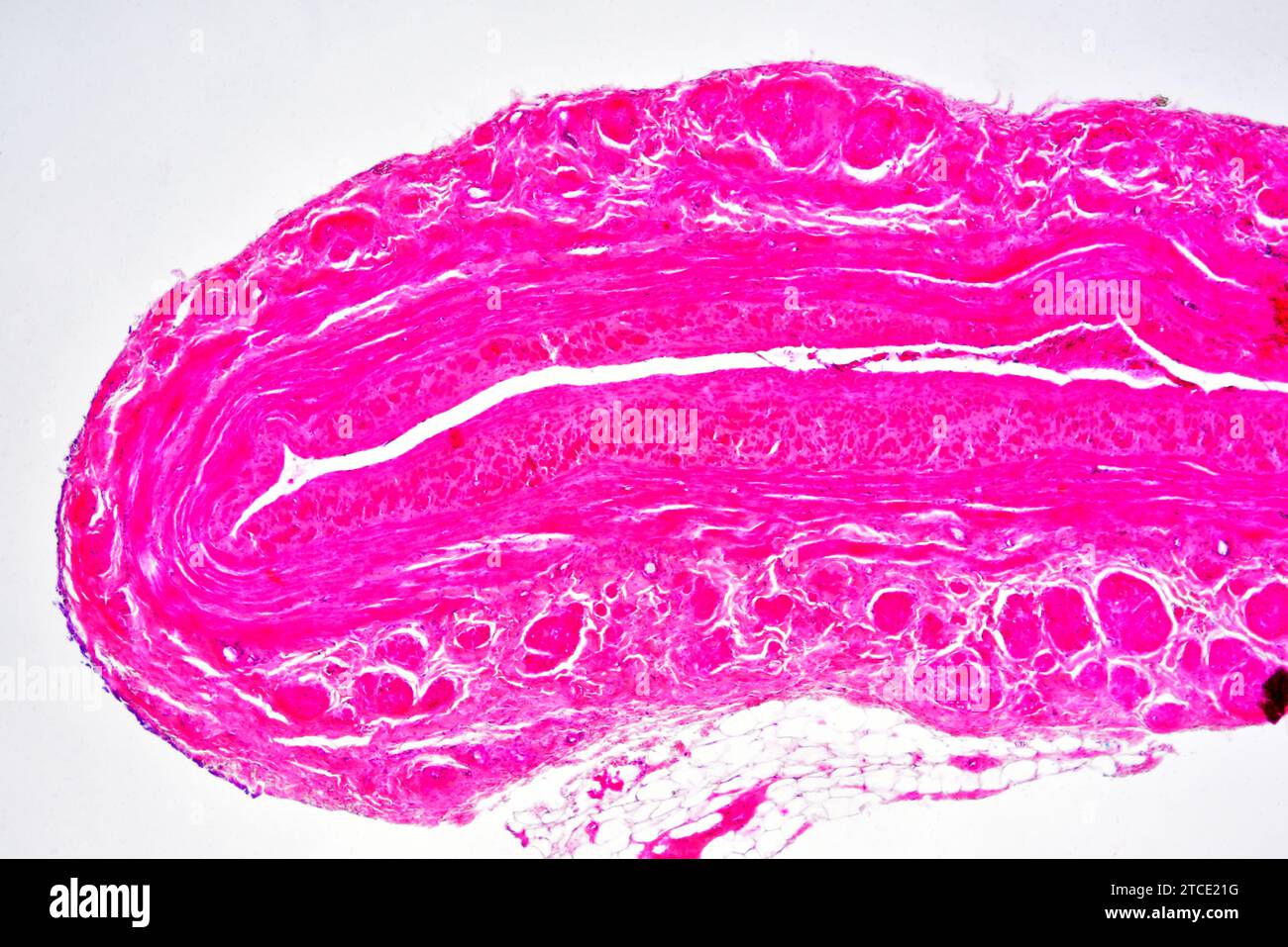 Human coronary artery with arteriosclerosis. Optical microscope X40 ...