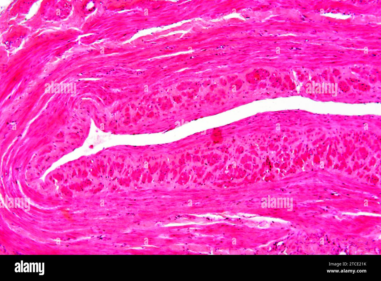 Human coronary artery with arteriosclerosis. Optical microscope X100 ...