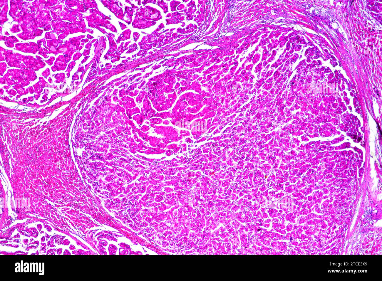 Human liver with metastatic carcinoma. Optical microscope X40 Stock ...
