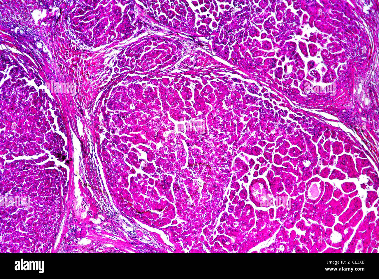 Human liver with metastatic carcinoma. Optical microscope X40 Stock ...