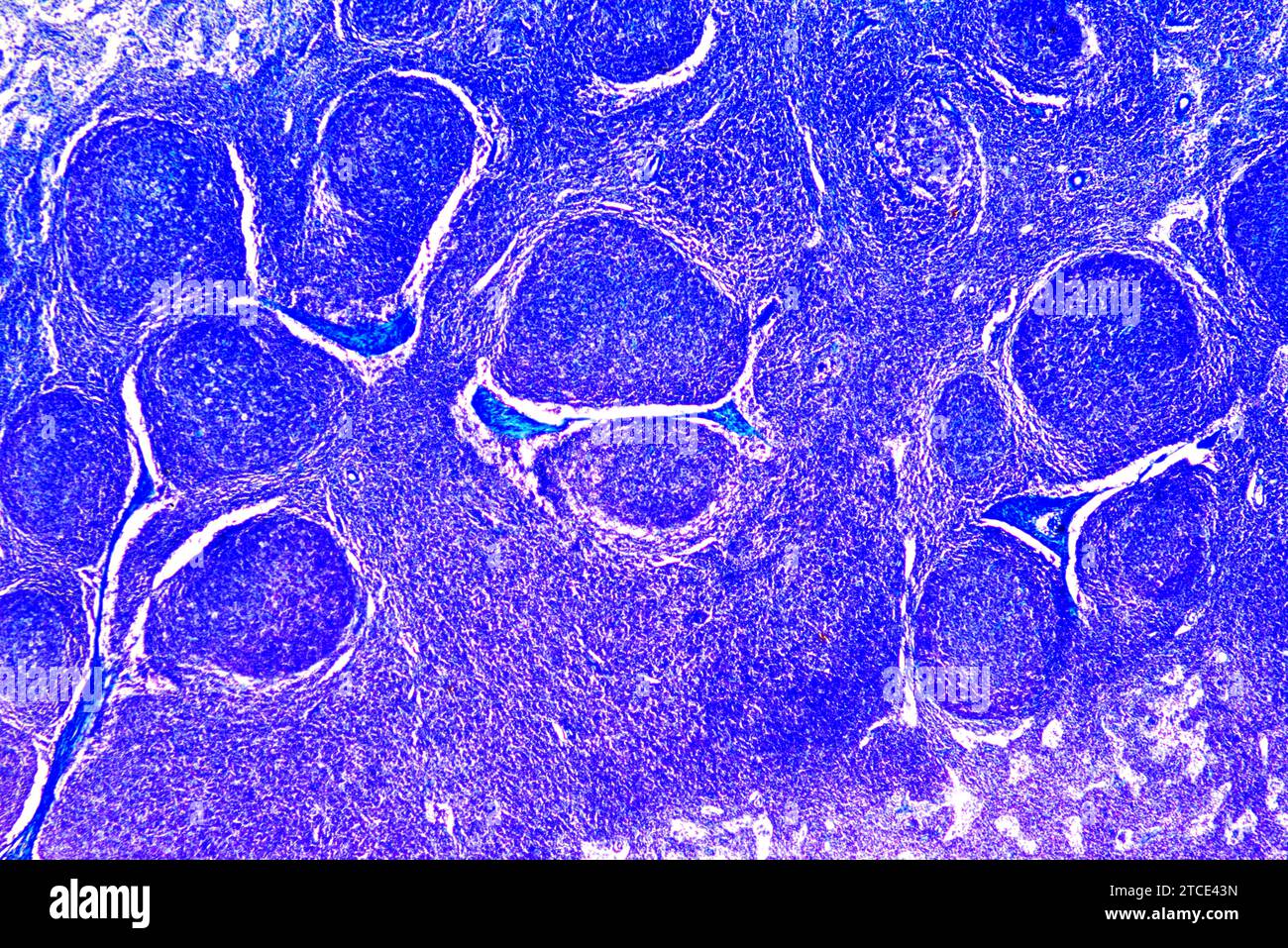 Lymph node micrograph hi-res stock photography and images - Alamy